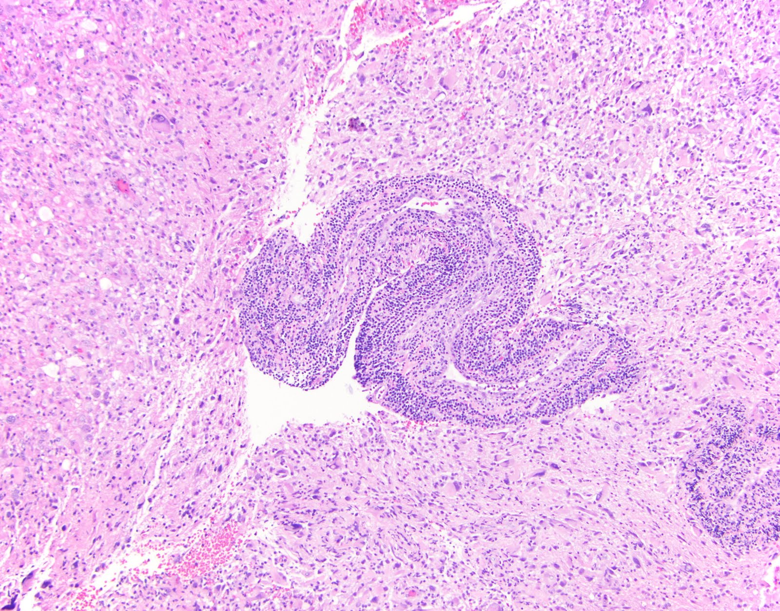 neuropathology blog: Giant cell GBM masquerading as an anaplastic PXA