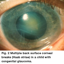 Eye 2 Eye Optometrists: Pediatric Glaucoma