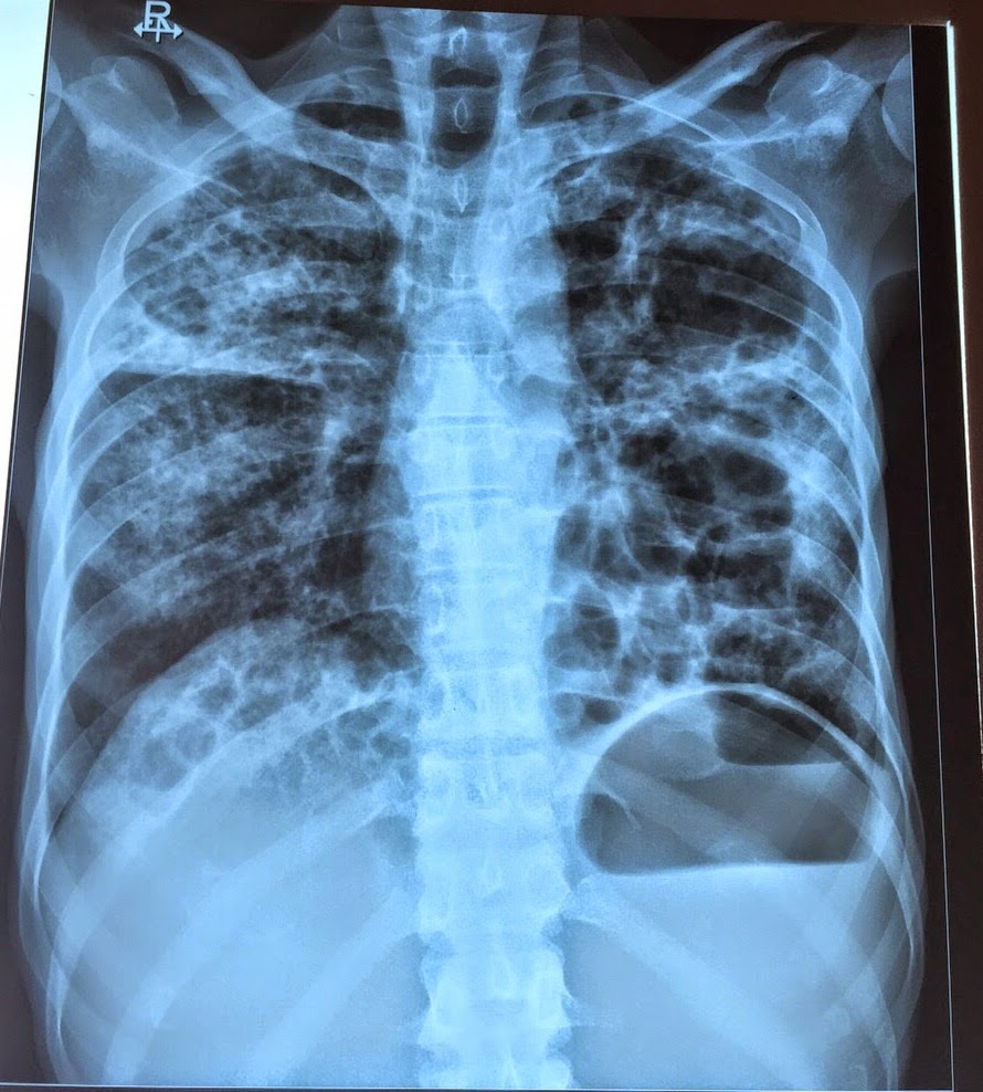 Chest Archives: chest X ray - Bronchiectasis