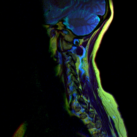 Nevit's blog: Cervical spine Color MRI