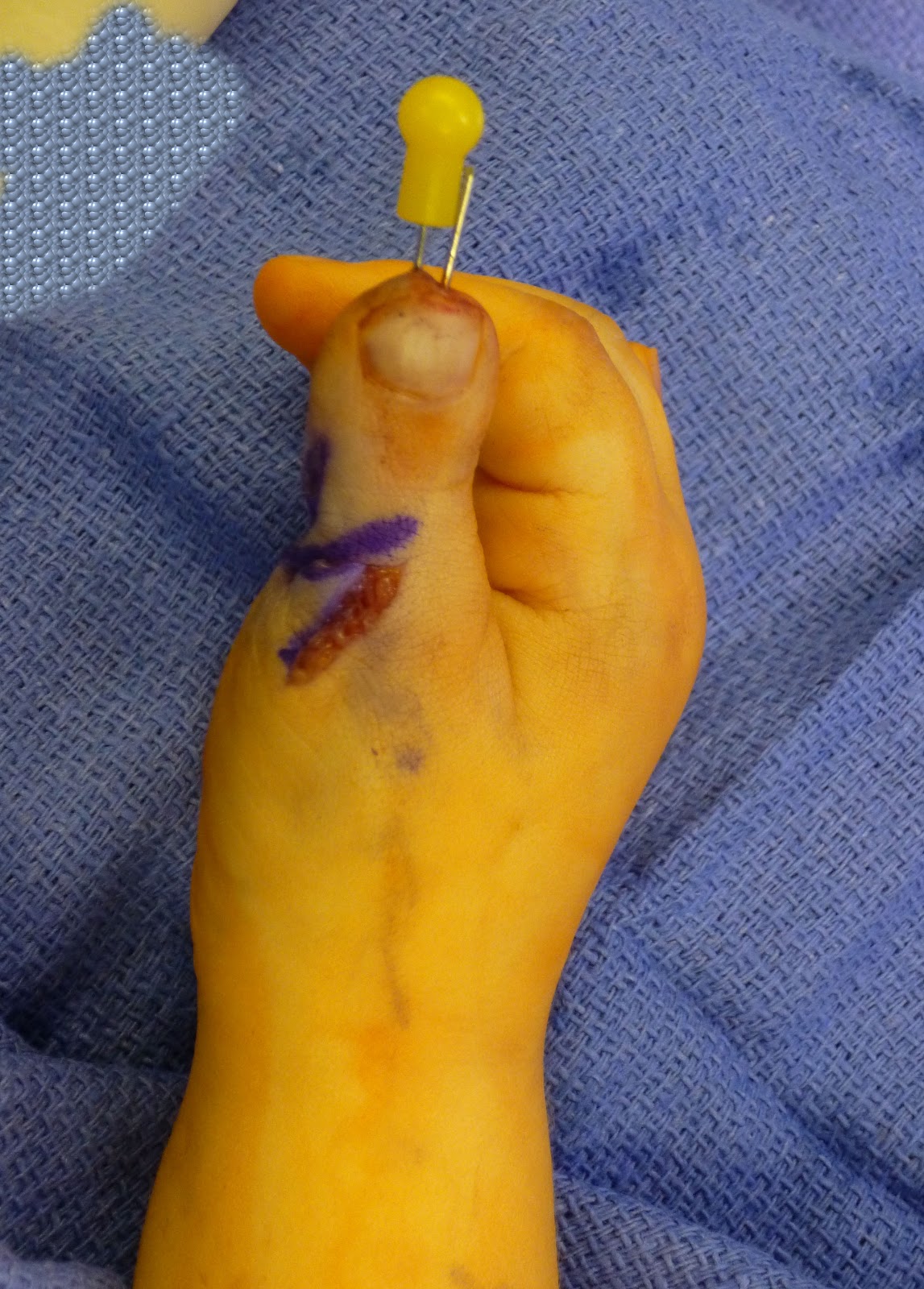 Clinodactyly | Congenital Hand and Arm Differences | Washington ...