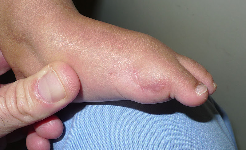 Toe Polydactyly | Congenital Hand and Arm Differences | Washington ...