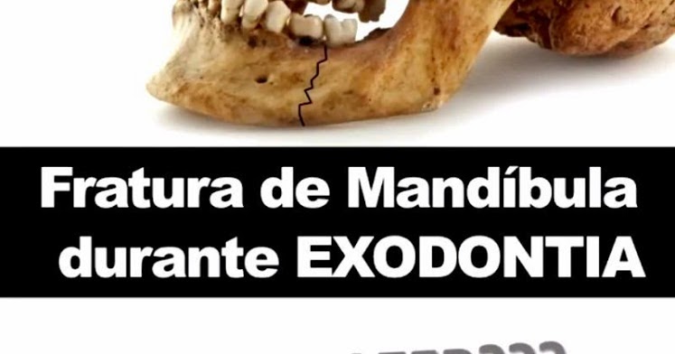 Fratura Mandibular Durante EXODONTIA. O que fazer? Como evitar? - Odonto-Tv