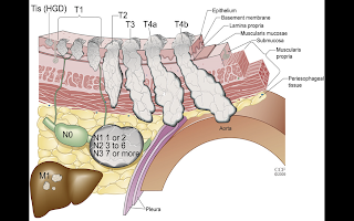 Patología de Esófago: ADENOCARCINOMA DEL TERCIO DISTAL DEL ESOFAGO ...