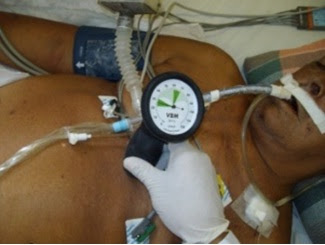 Blog da Fisiocursos Manaus: AVALIAÇÃO DA PRESSÃO INTRA-CUFF EM ...