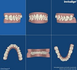 Dentista de modelos: Invisalign - Aparelho invisível