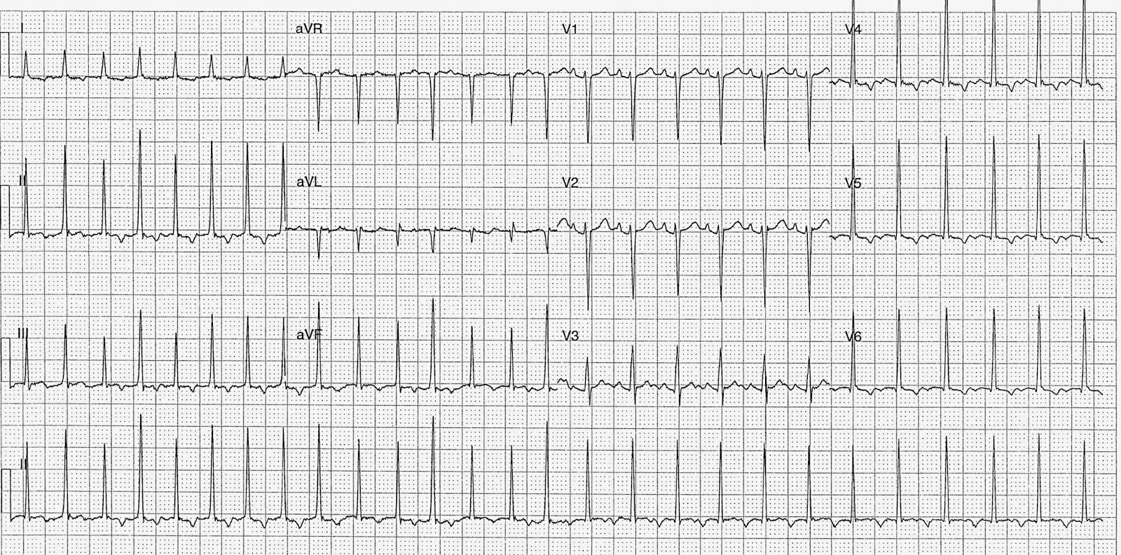 ECG of the Week: ECG of the Week - 12th October 2015 - Interpretation