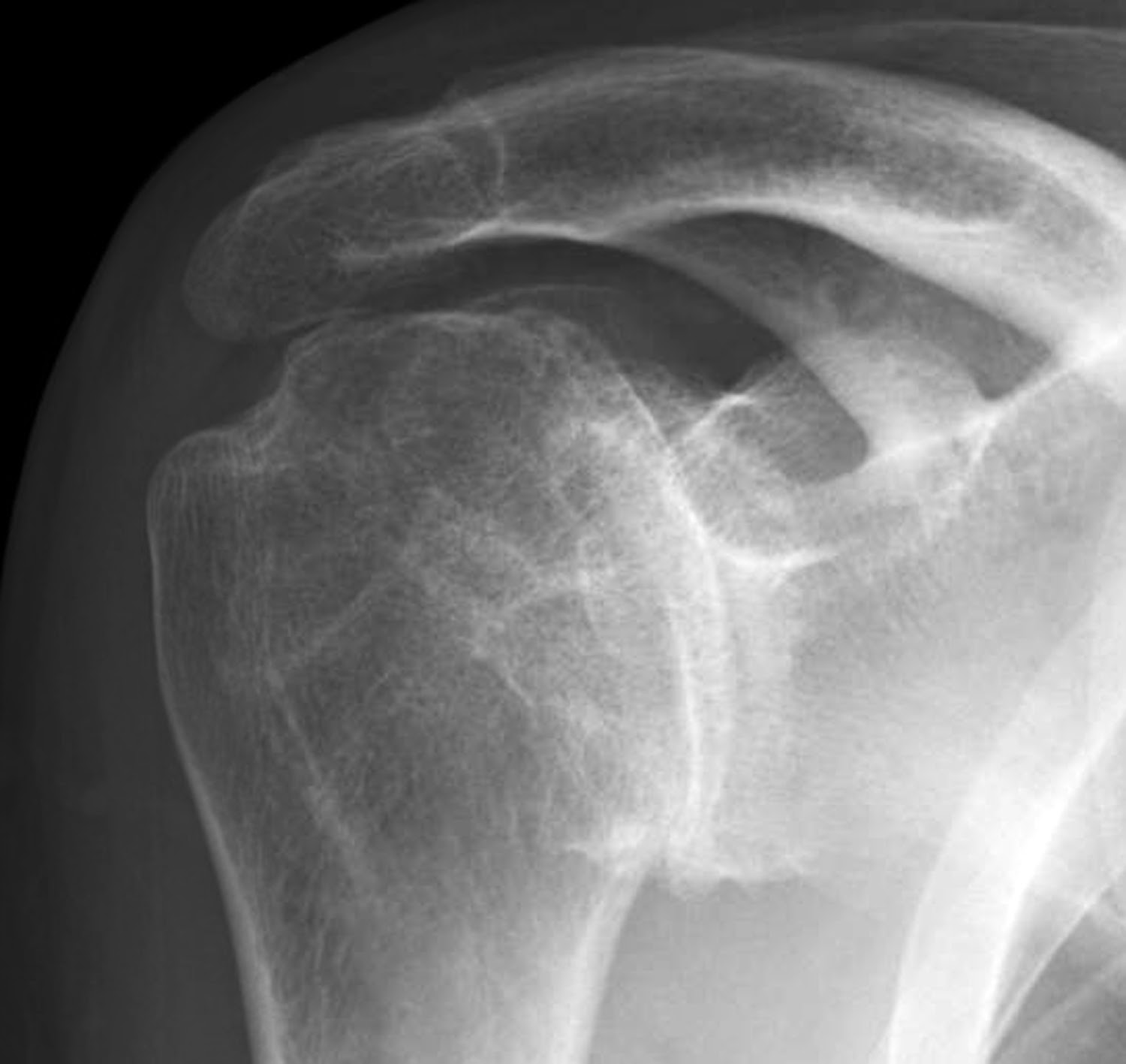 UW Shoulder and Elbow Academy: Shoulder joint replacement - many ...