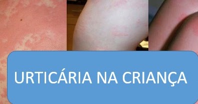 Urticária na criança