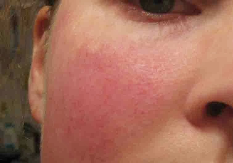 Scarlet Letters, dealing with vascular rosacea, face flushing, burning ...