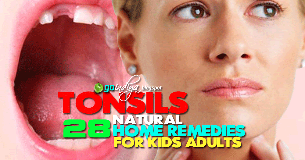 28 Best Natural Home Remedies for Tonsillitis in Kids and Adults ...