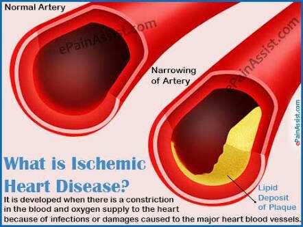 Ischemic Heart Disease: Symptoms, Causes, Treatment and Prevention ...