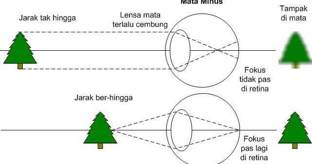 Pengertian Daya Akomodasi Mata, Punctum Proximum dan Punctum Remotum
