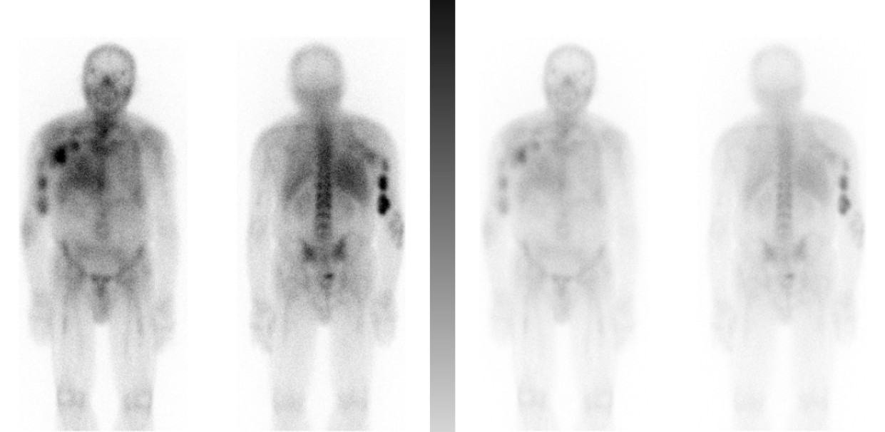 NuCleaR MuNkeE: Unusual Gallium Localization - B-Cell Lymphoma