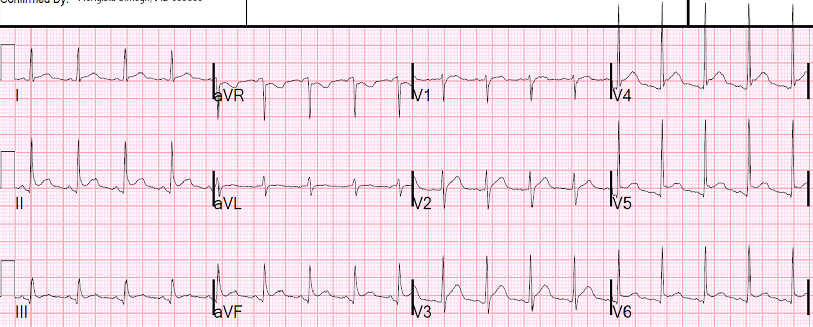 Dr. Smith's ECG Blog: ECG of pneumopericardium and probable myocardial ...