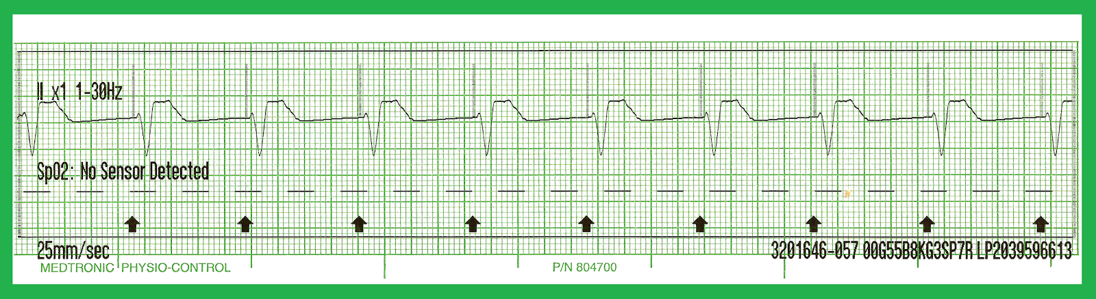 EKG Rhythm Quiz 226