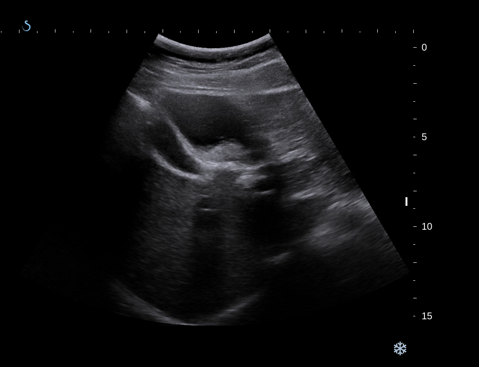Lesser Sac Ultrasound