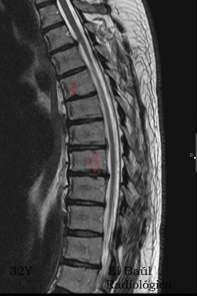 El Baúl Radiológico: ENFERMEDAD DE SCHEUERMANN (DORSALGIA JUVENIL ...
