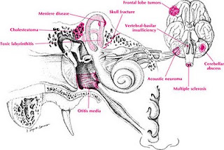 Penyakit Vertigo | BIOLOGIPEDIA