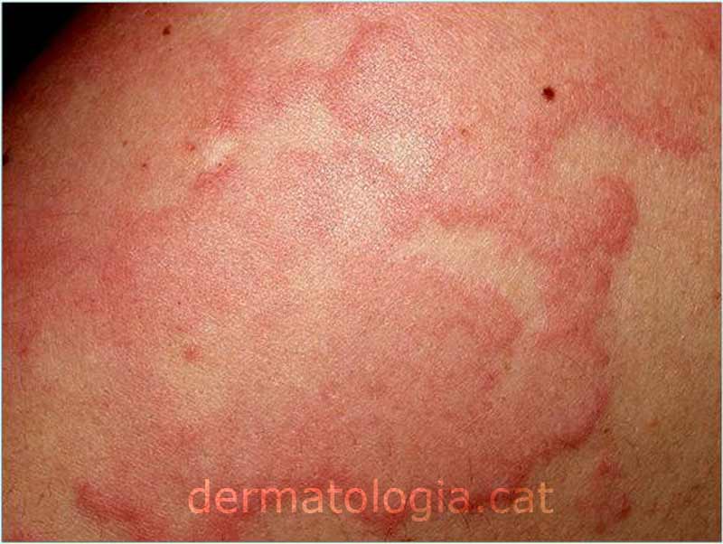 Control de Plagas en Sanidad Ambiental: Urticaria 1