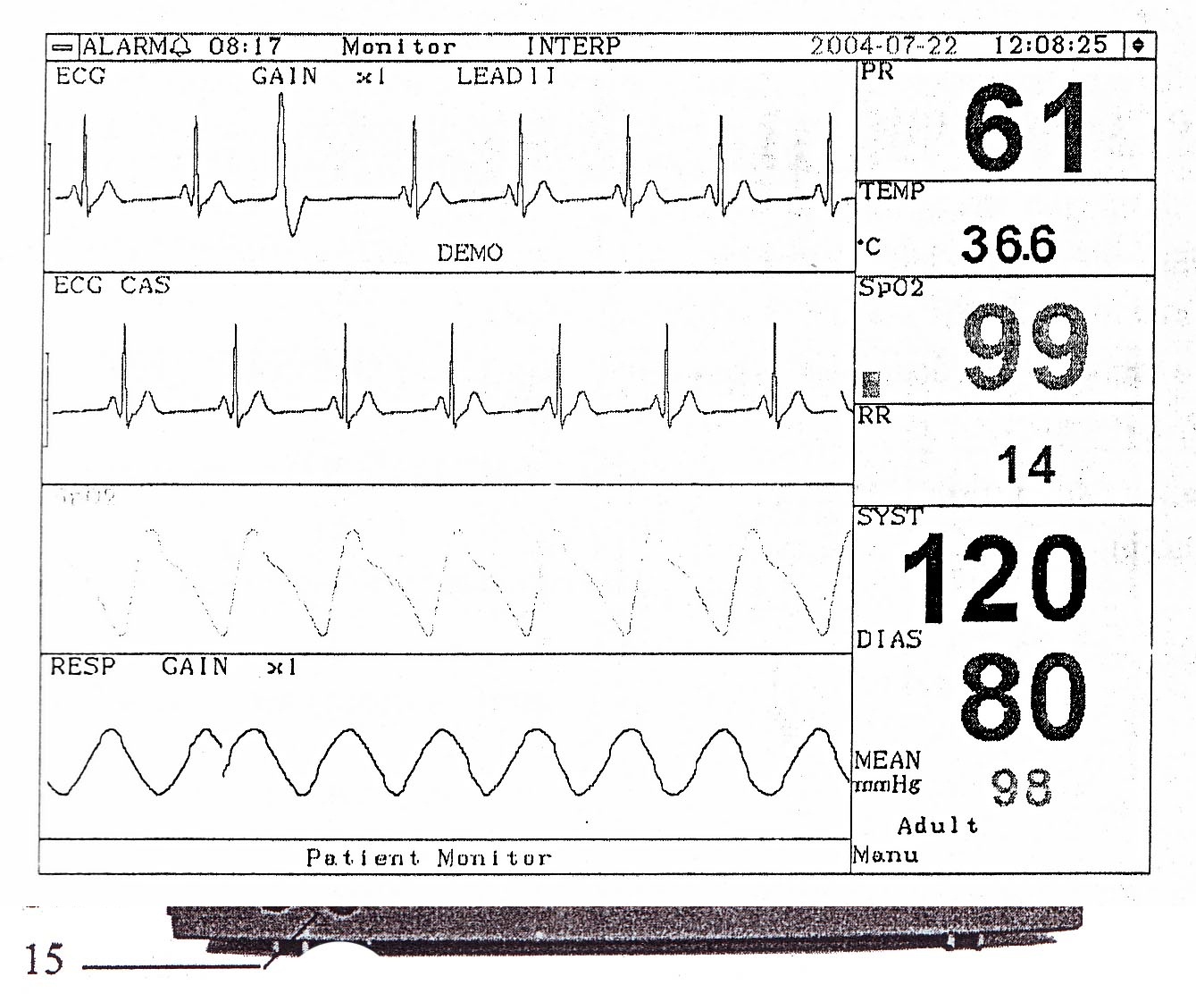 mulai baru lagi: Pasien monitor Analogic ASC-553