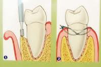 Dental Problems Treatments: Periodontal Flap Surgery---For a Painless ...