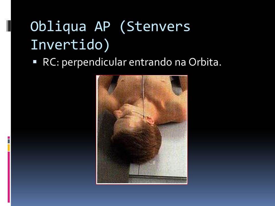 Radiologia Dinâmica: Metodo de Stenvers Invertido - Chaussé IV - Mayer ...