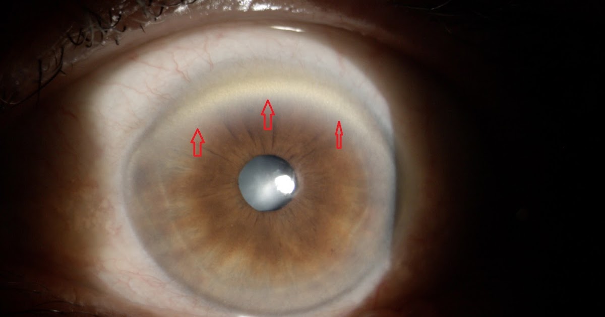 ARCO CORNEAL (2 fOTOS)