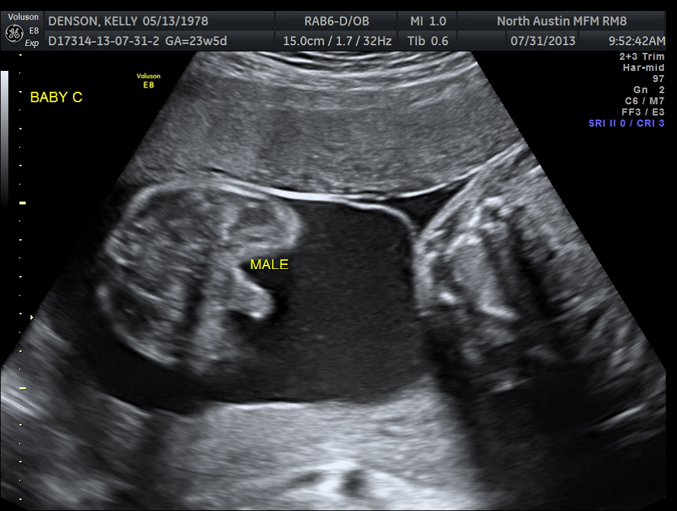The Texas Trio: A Triplet Pregnancy Blog: Ultrasound pics