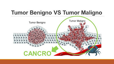 Professor Romário: Tumor Benigno x Tumor Maligno