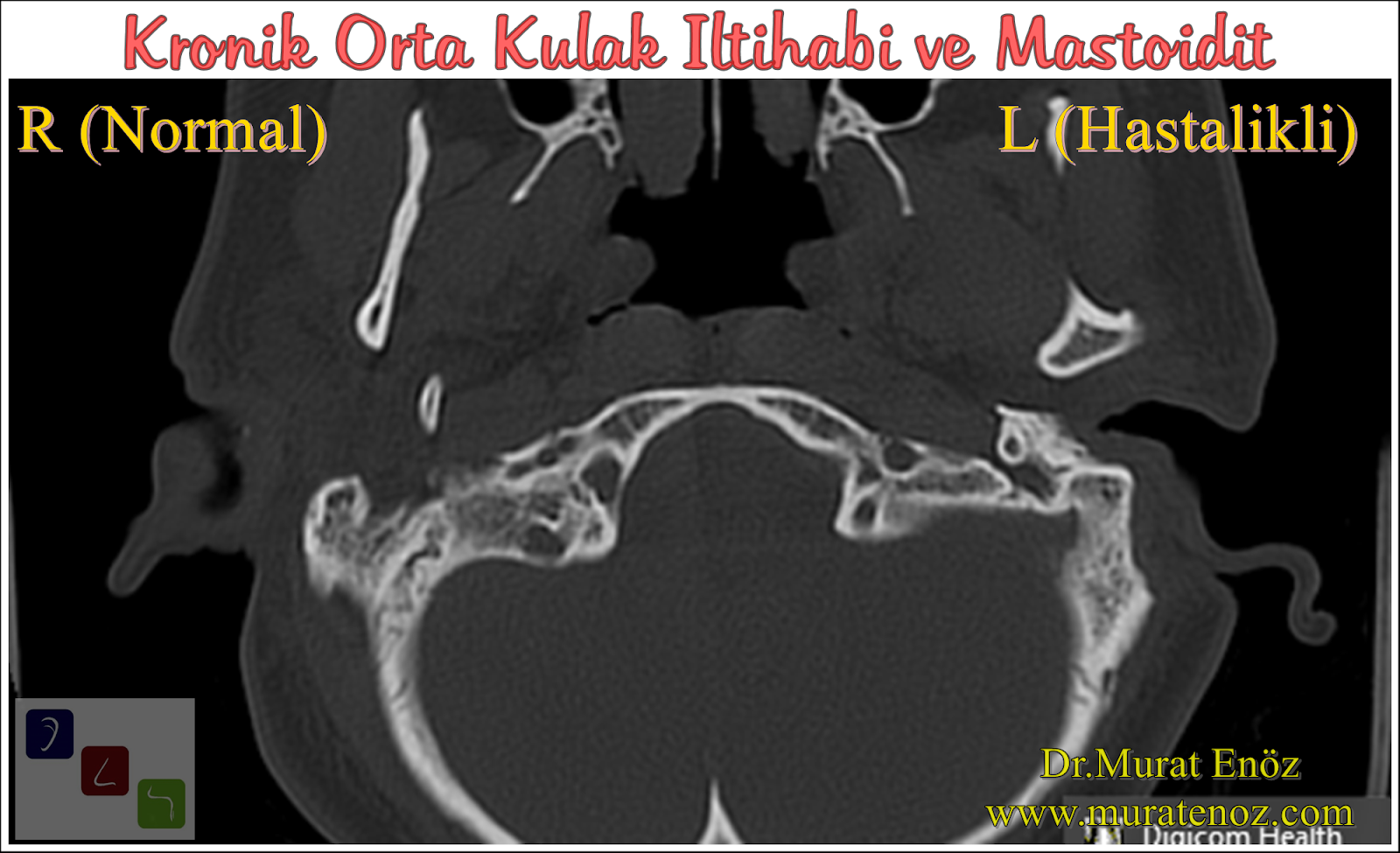 Kronik Orta Kulak İltihabı ve Mastoidit