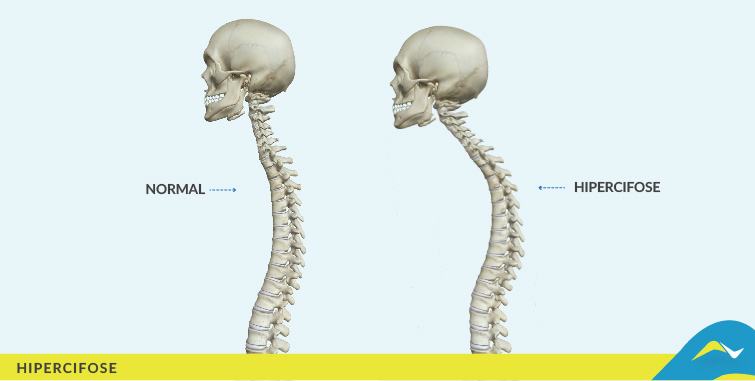 Patologias – Hipercifose – Coach Carlos