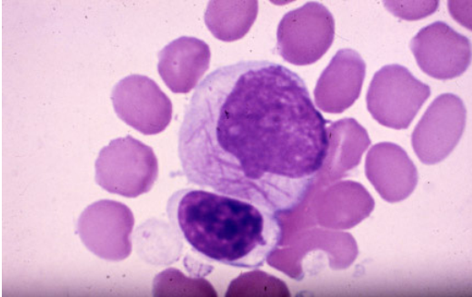 VETERINARY HEMATOLOGY DEXTERVET: Leucemia promielocítica aguda (Acute ...