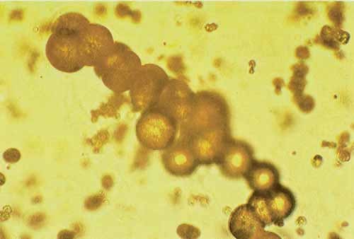 Atlas of Crystals found in alkaline urine | Free Medical Atlas