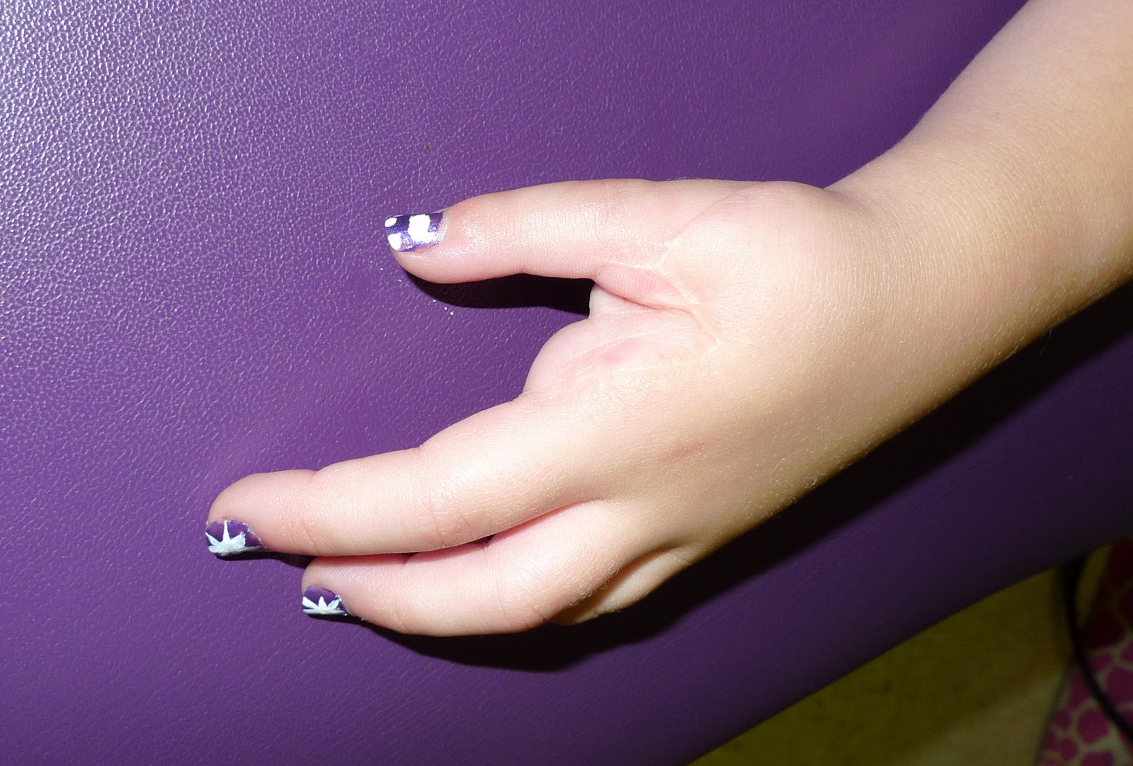 Pollicization- Creating a New Thumb | Congenital Hand and Arm Differences