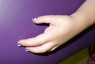 Pollicization- Creating a New Thumb | Congenital Hand and Arm ...