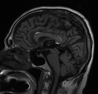 Dr Balaji Anvekar FRCR: Corpus callosal Lipoma