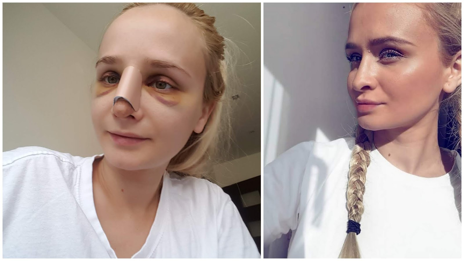 Operácia Nosa : VIDEO - Fotky pred a po