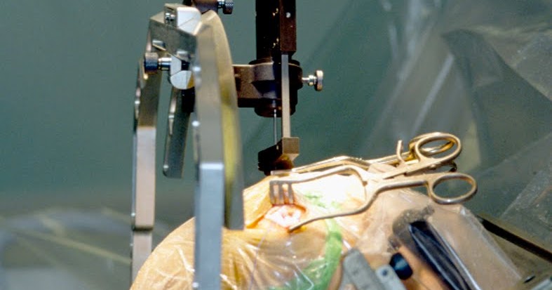 New Tool Developed To Monitor Patients Undergoing Deep Brain ...