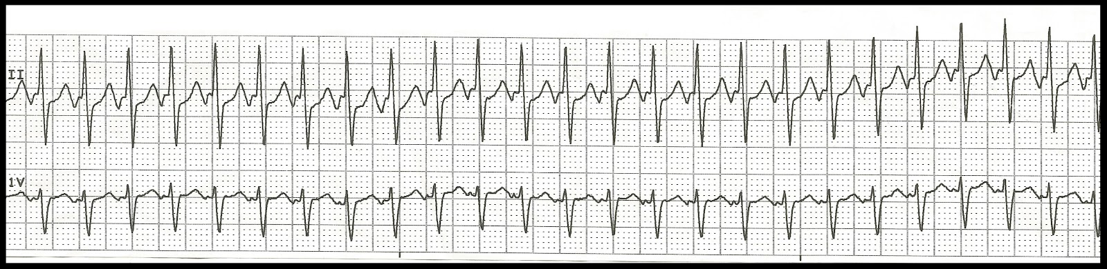 Practice ECG Rhythm Strips 100