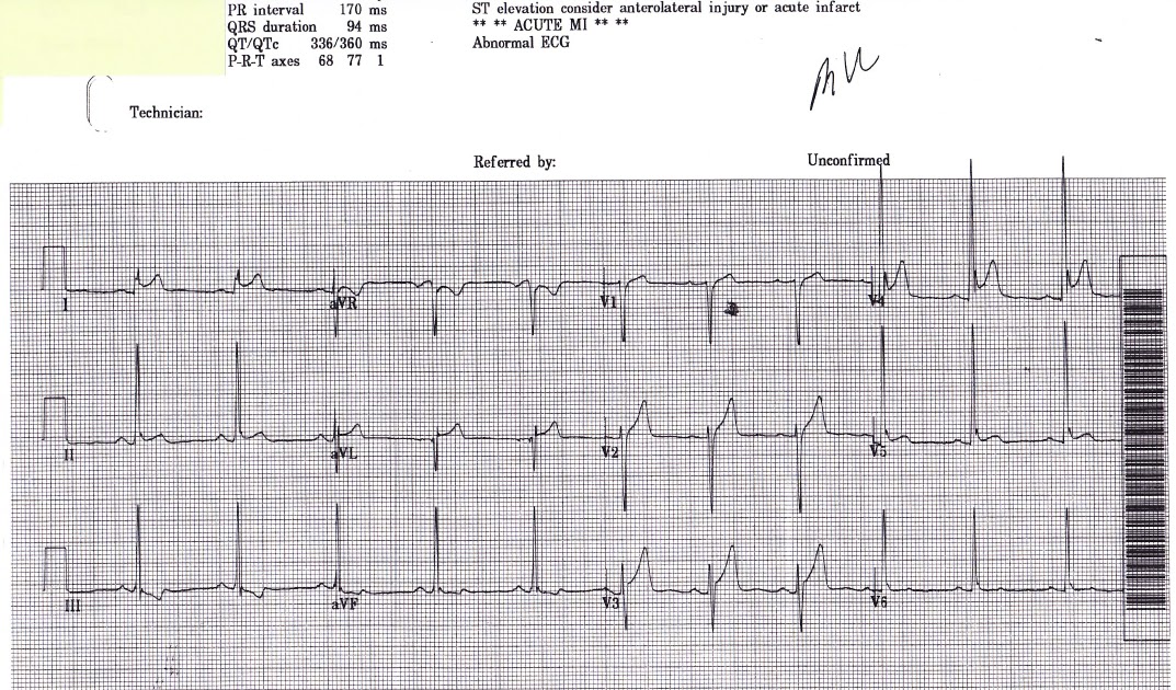 Doc Cottle's Desk: Benign early repolarization