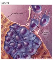 Matthew Taub | Blogspot: Four Types of Benign Tumors