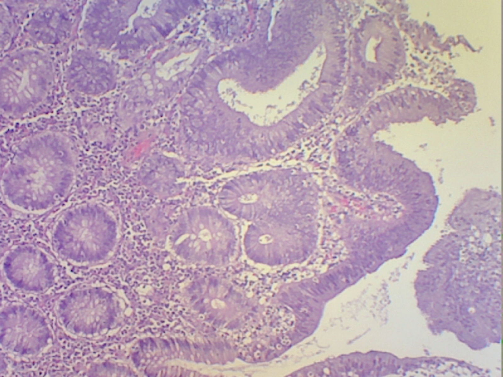 CUCI con displasia. | Consultoria en Anatomía Patológica y Medicina