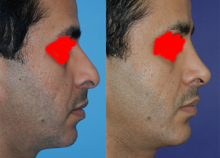 Burun Estetiği resimleri