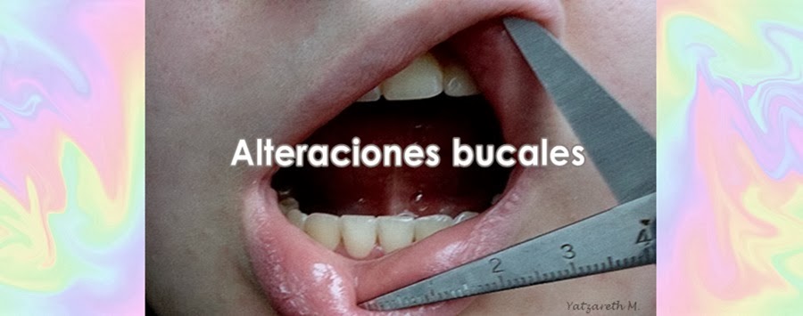 Alteraciones bucales: Línea alba oclusal