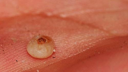 5 Parasit yang Hidup di Kulit Manusia - Informasi dan Cara Kerja Unik