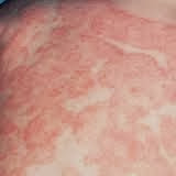 PENGERTIAN ALERGI, PENYEBAB DAN GEJALA ALERGI - E-JURNAL