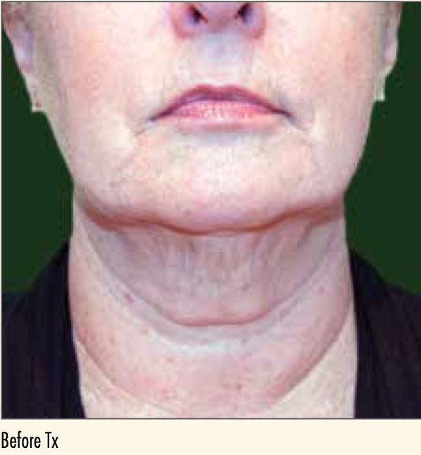 Perfect Body Laser and Aesthetics: Non-Surgical Neck Lift