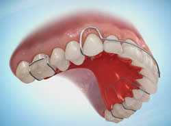 Clear Orthodontic Retainers: Clear Orthodontic Retainers