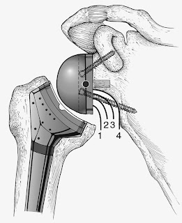 What's a Reverse Total Shoulder?